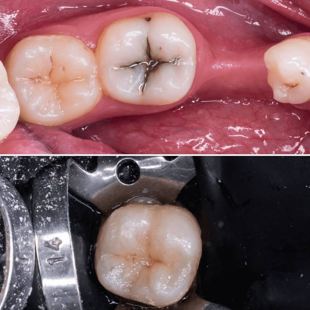 Resina dental